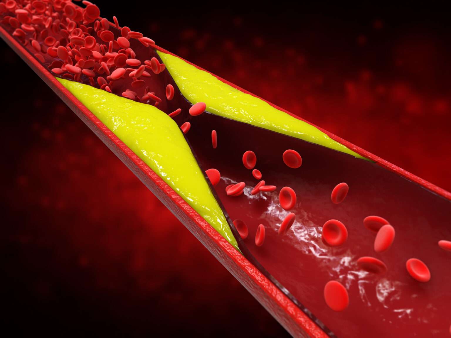 Thrombose: Ursachen, Symptome & moderne Behandlung