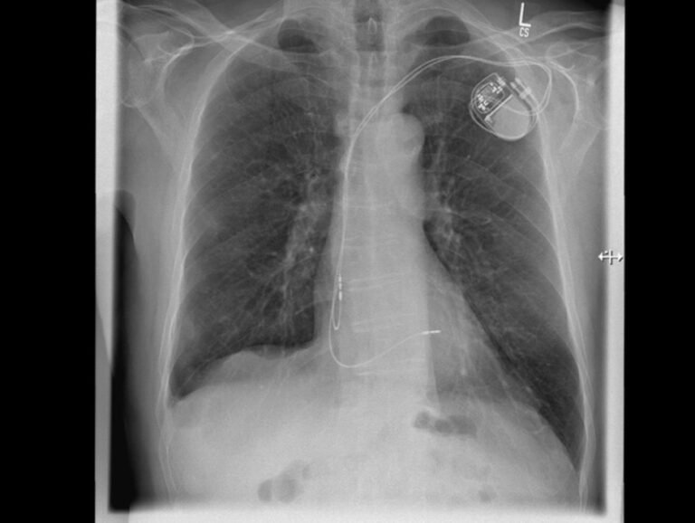 Katheterablation bei Vorhofflimmern: Behandlung und Erfolgsaussichten