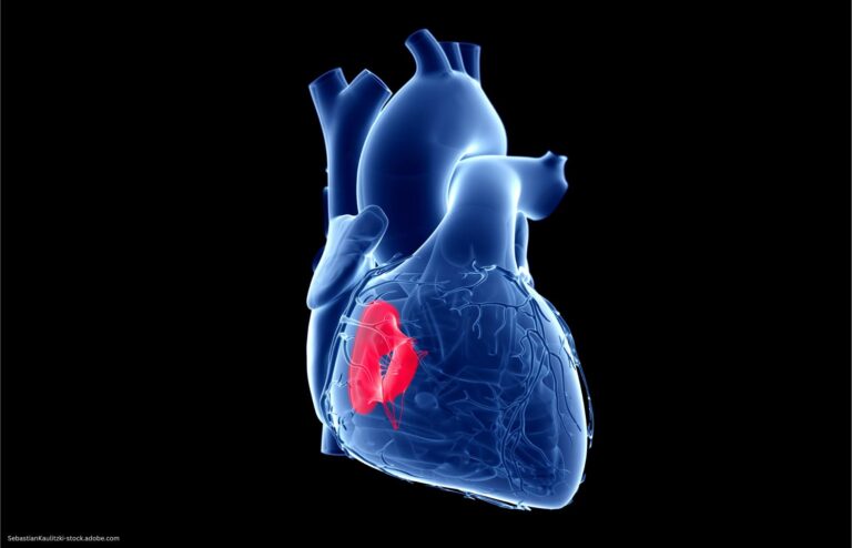 Katheterablation bei Vorhofflimmern: Behandlung und Erfolgsaussichten