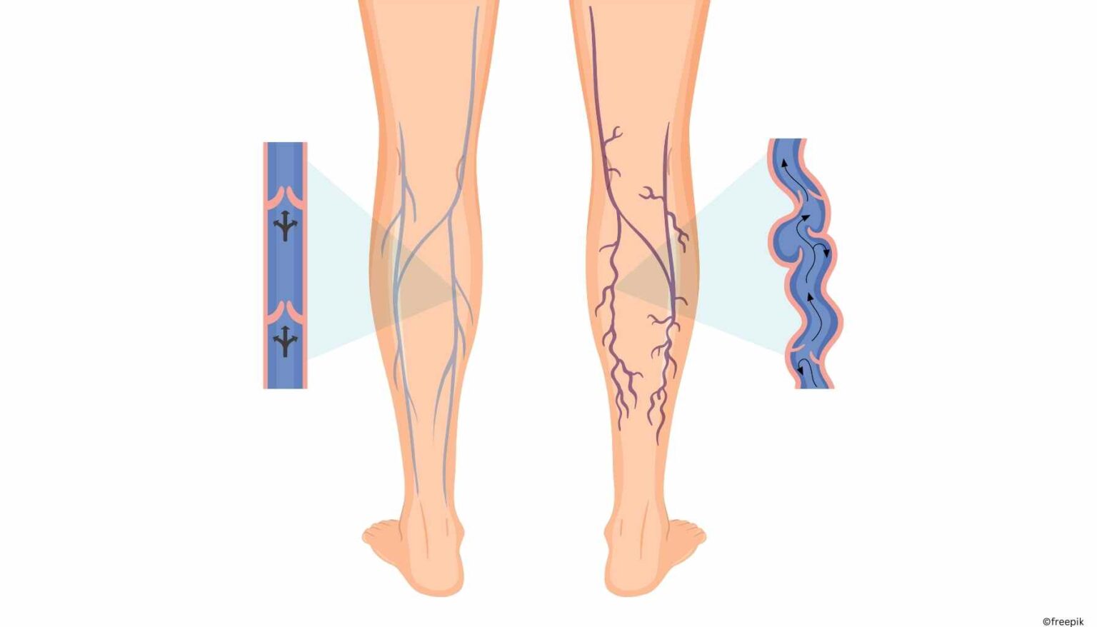 Thrombose erkennen: Symptome, Ursachen & Behandlung